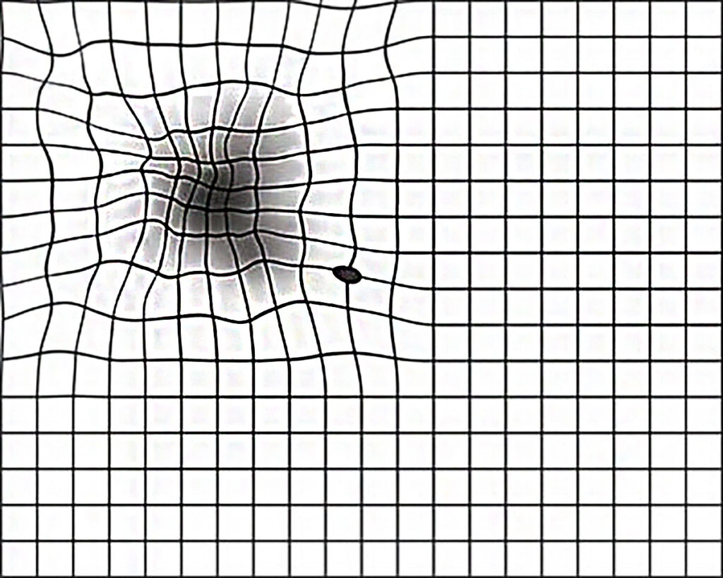 Amsler grid test | Vantage Eye Center