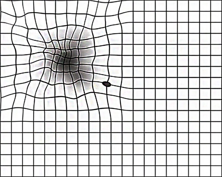 Amsler grid test | Vantage Eye Center