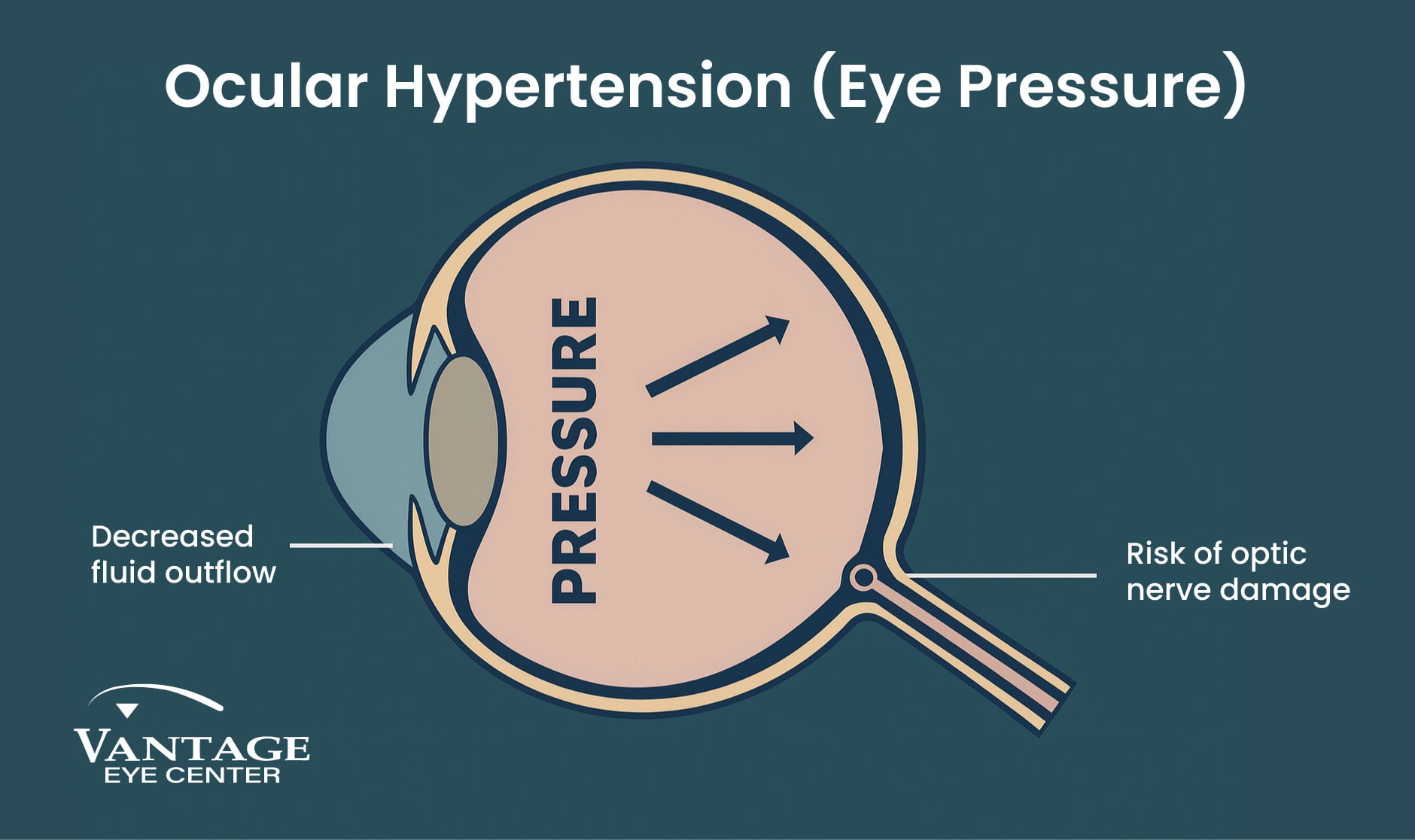 Ocular Hypertension | What are the Causes and How To Reduce It